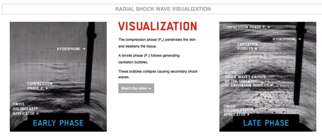 Shockwave | Oceanside Physio