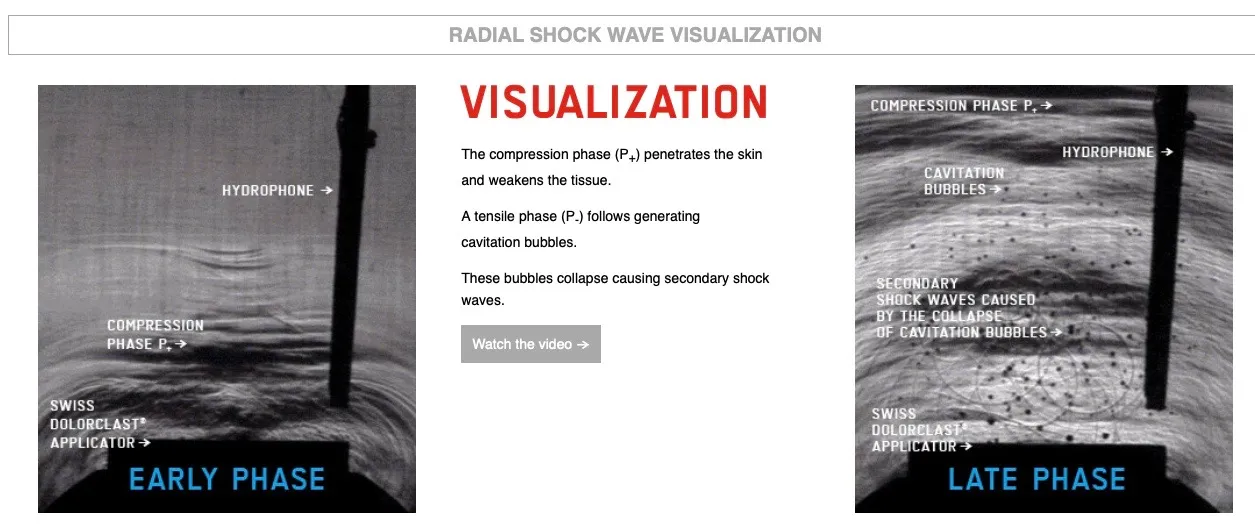 Shockwave | Oceanside Physio